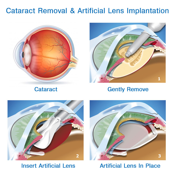 Cataracts - Dr. Calotti - Great Lakes Eye Centre in Brantford Ontario