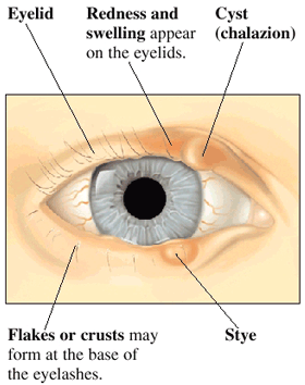 Blepharitis and Dry Eyes- Dr. Calotti - Great Lakes Eye Centre in ...